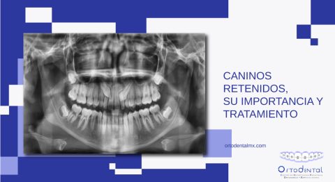 Caninos retenidos, su importancia y tratamiento - Ortodental